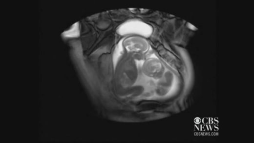 Twins Fighting in Womb: Captured on Video! - The Hollywood Gossip