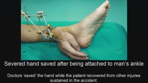 Hand Attached to Ankle of Man After Accident Severed It: Watch! - The ...