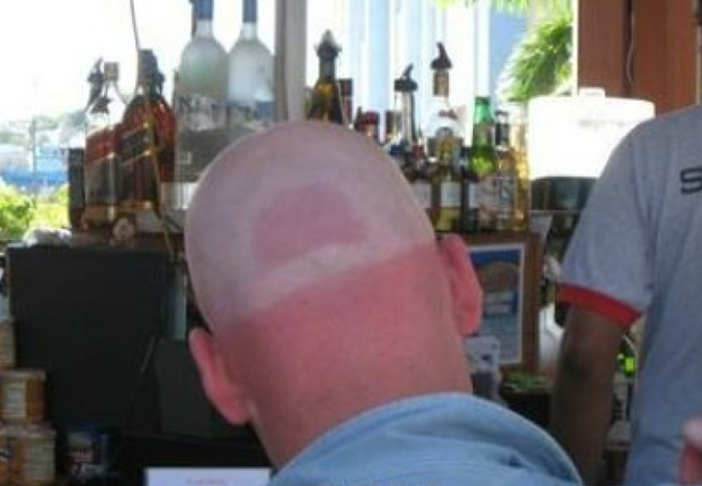 19 Truly Terrible Sunburns - The Hollywood Gossip