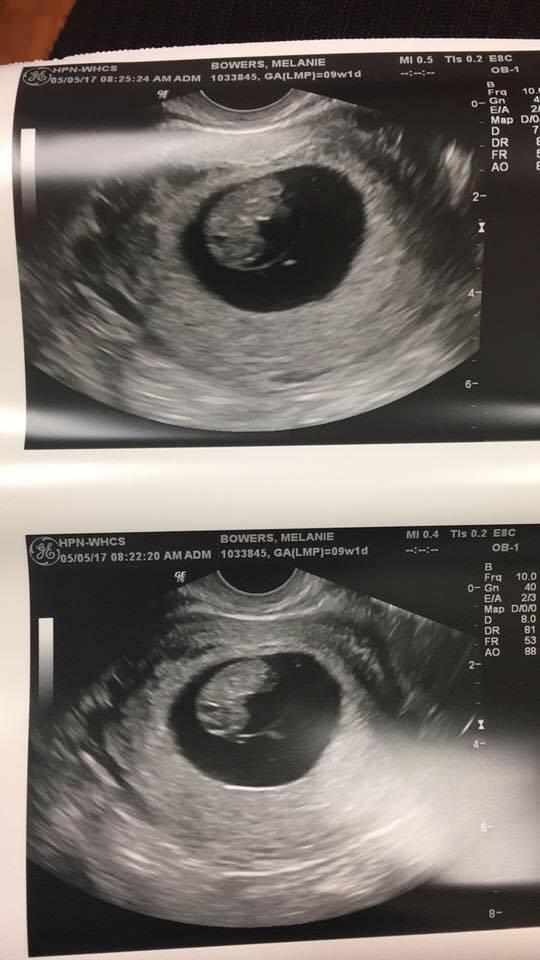 a sonogram - The Hollywood Gossip