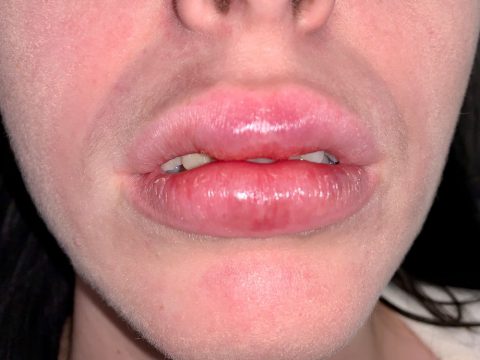 Deavan Clegg Reveals Horrifically Botched Lips: HELP! - The Hollywood ...